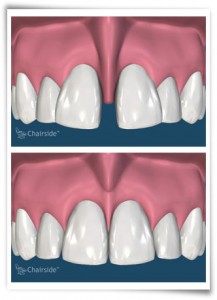 Frenectomy | Frenum | St. Peters MO | St. Louis OMS | Oral Surgery